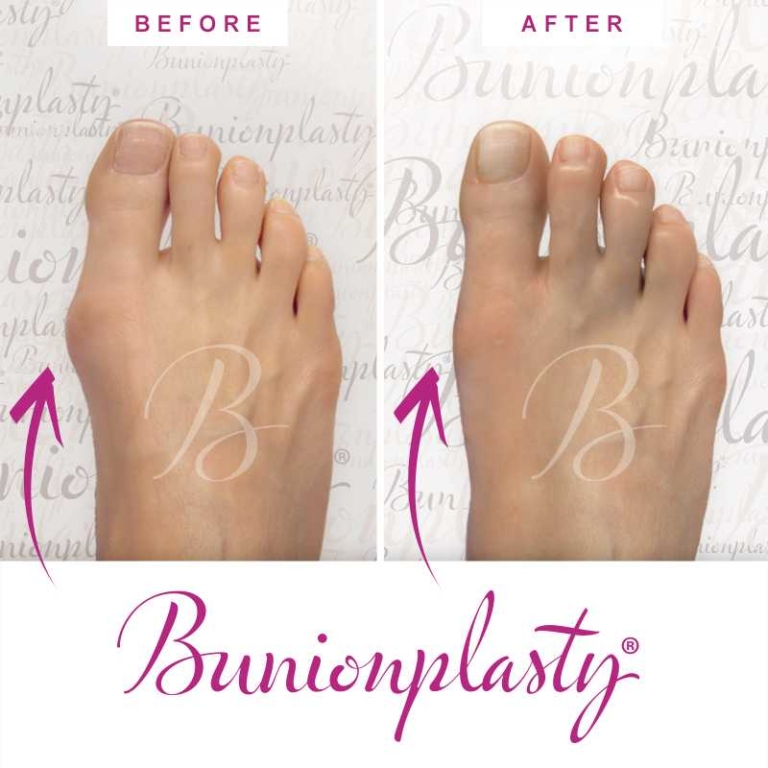 Bunionplasty® Procedure & More | Before & After | The Bunion King®