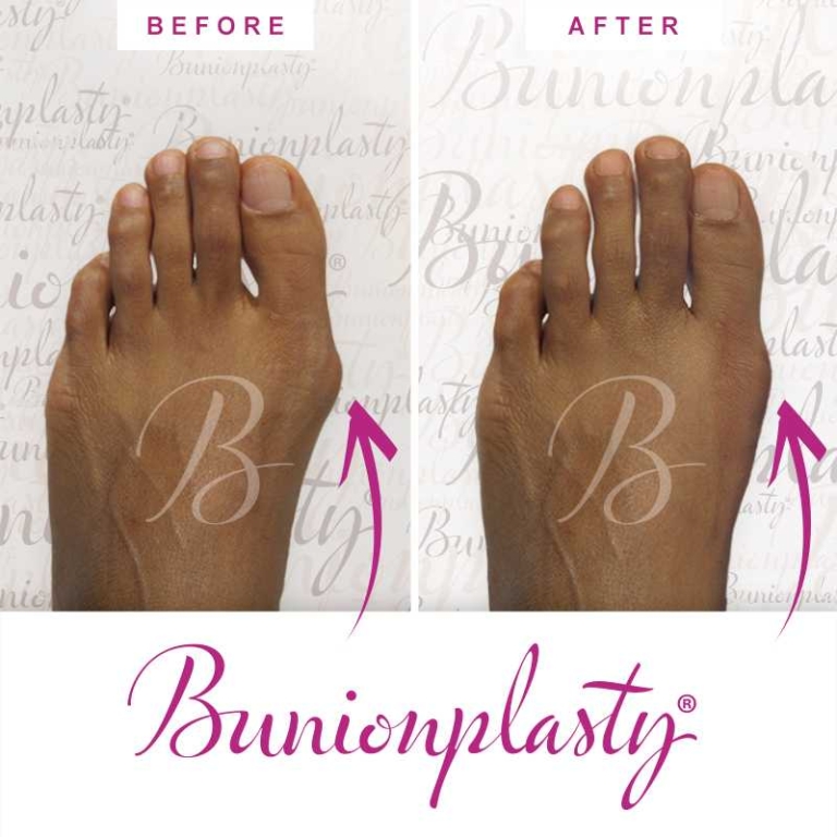 Bunion Surgery Results Gallery Before & After Photos | Be Bunion Free®