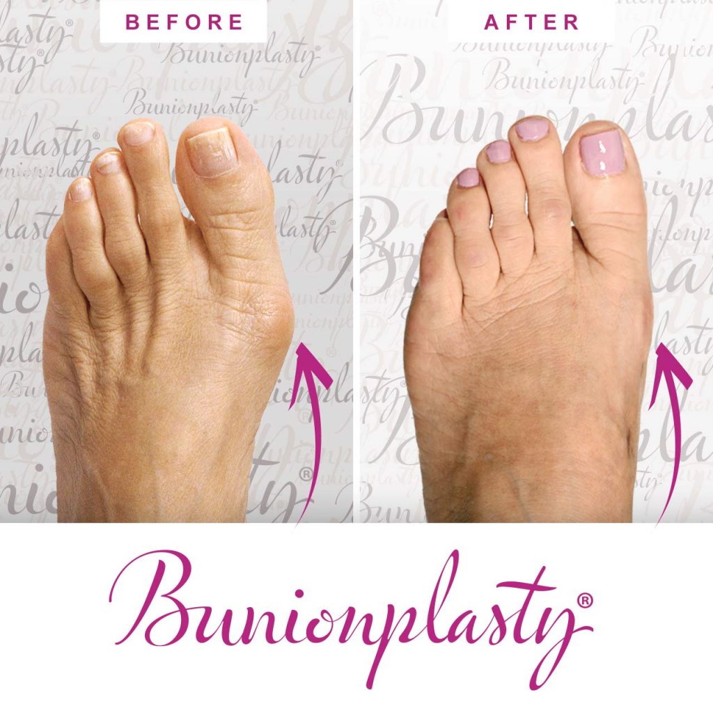 Hallux Varus | Procedures in NYC & Beverly Hills | Dr Neal Blitz