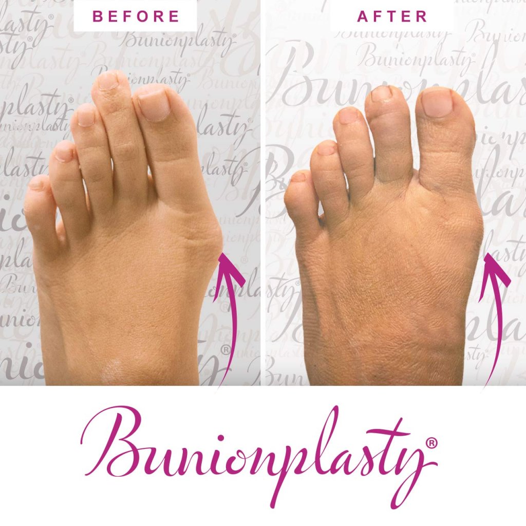 Hallux Varus | Procedures in NYC & Beverly Hills | Dr Neal Blitz